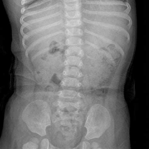 Transverse Scan With A Curvilinear Transducer Showing The Presence Of Download Scientific