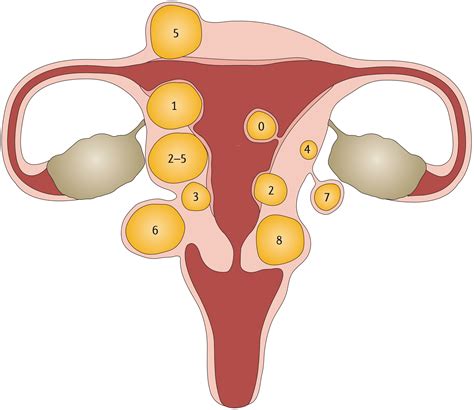 Transforming Fibroid Care Gynelogic