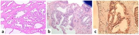 Cribriform Patterned Lesions In The Prostate Gland Encyclopedia Mdpi