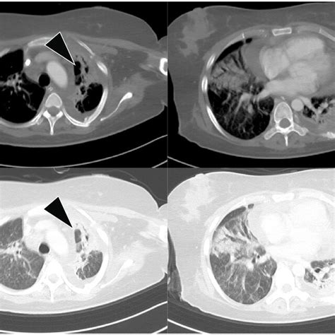 Computed Tomography Findings On Admission Enhanced Computed Tomography Download Scientific