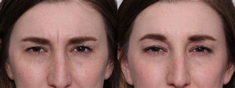 The Differences Between Daxxify And Botox What You Need To Know