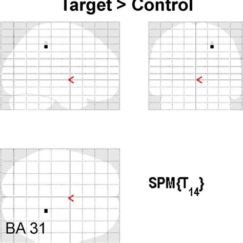 Statistical Parametric Map Statistical Parametric Map Of The Brain
