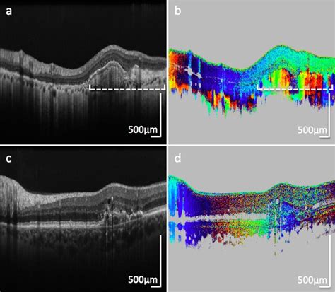 PS OCT Intensity B Scans A C And PS OCT Axis Orientation B Scans C Download Scientific