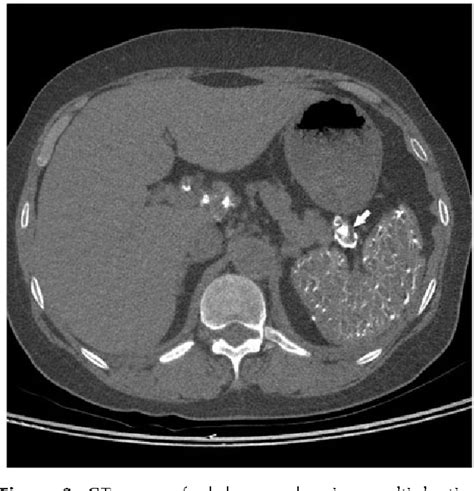 Silicosis Eggshell Calcification