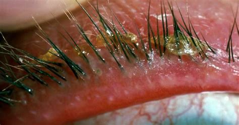 Blepharitis Medical Centric