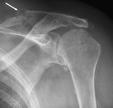 Patient 1 X Ray Of Left Shoulder Showing Scapular Spine Fracture Two