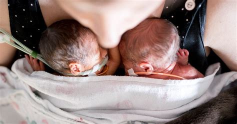 Conjoined Twins Development Delivery And Separation