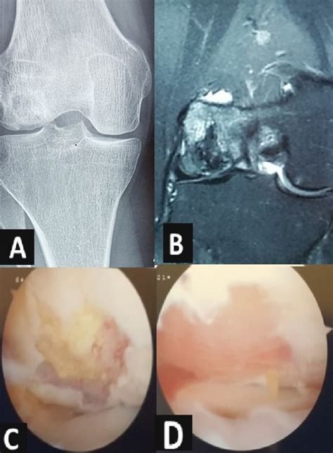 Knee Subchondral Stress Fracture