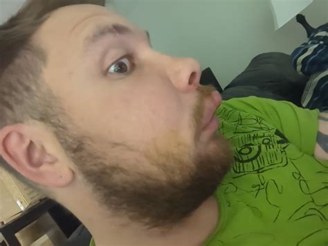 1st Day And 5 Days Post Op Upper Jaw Surgery R Jawsurgery