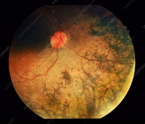 Pigmentary Retinopathy Fundoscopy Stock Image C0554261 Science