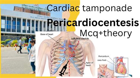 Cardiac Tamponadepericardium Pericardiocentesisfastbeck Triadexams