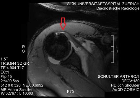 Ortho News Subscapularis Tears