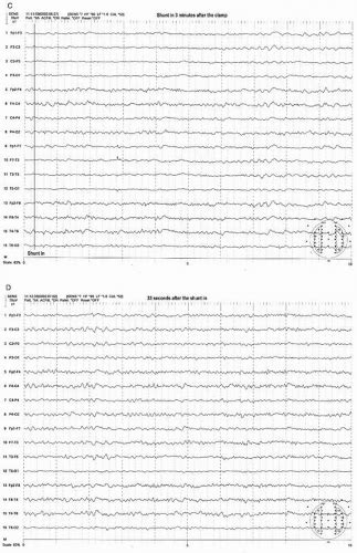 Monitoring Eeg During Carotid Surgery Neupsy Key