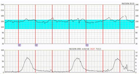 Fetal Tracing Index Electronic Fetal Monitoring