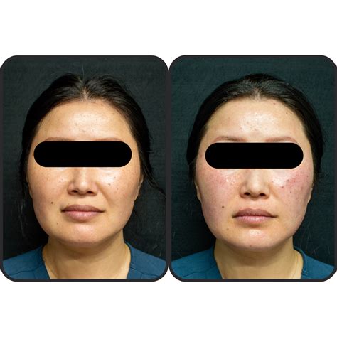 Helios 785 Pico — Laseroptek