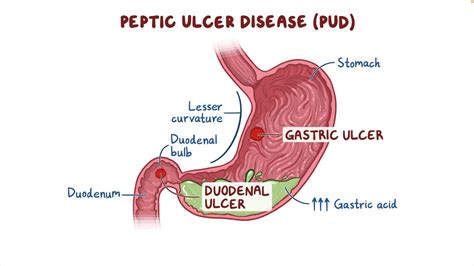 Peptic Ulcer Disease Video And Meaning Osmosis