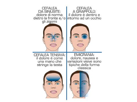 Cefalee Mal Di Testa Neurochirurgo Antonio Musio