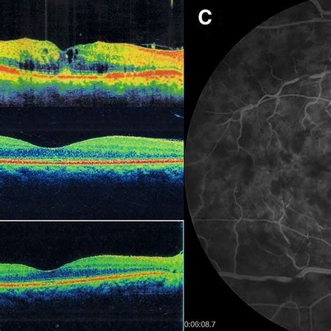 Serial Linear Oct Scan After Intravitreal Ziv Aflibercept Injections Download Scientific