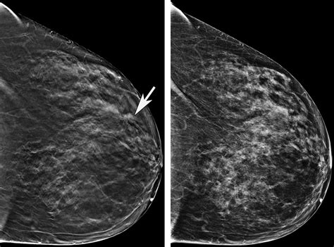 3d Mammography Creates More Precise Images To Detect Breast Cancer Shots Health News Npr
