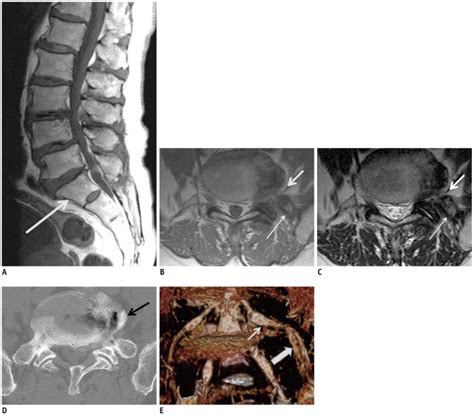 75 Year Old Man Presenting With Swelling Of Left L5 Nerve Root In