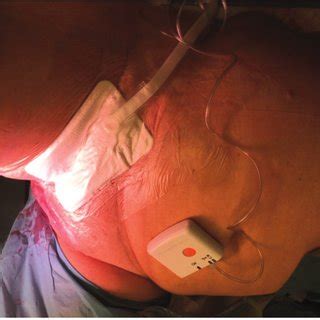 Tension Free Application Of The PICO Device Covering The Groin Download Scientific Diagram