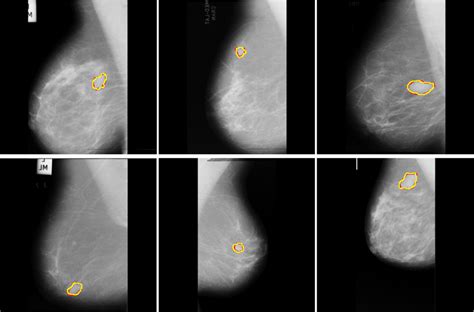 The Visual Assessment Of Breast Tumor Segmentation Using Our