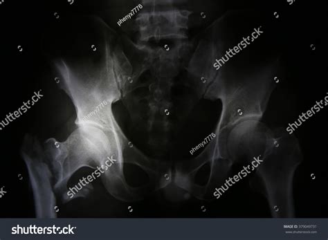 Xray Photos Bone Fracture Patients Stock Photo 379049731 Shutterstock