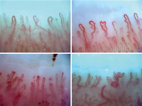 Polymyositis Anti Jo1 And Anti Ro52 Positive With Scleroderma Like