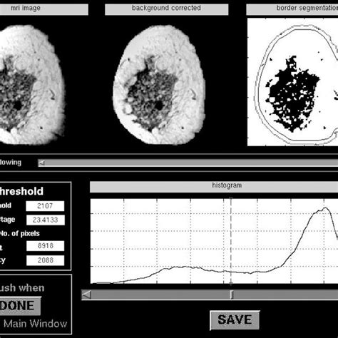 the flow chart for the segmentation of the fibroglandular tissue on mr