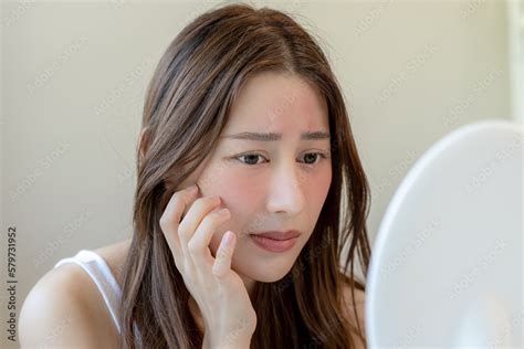 Woman Worried About Face Dermatology Rosacea Dermatitis Allergic