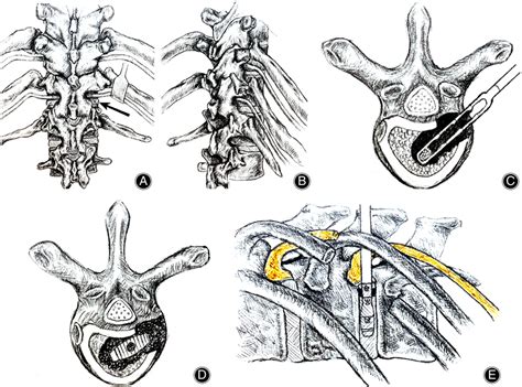 A Posterior View Of Lower Thoracic Segment T10 11 And T11 12 B Download Scientific Diagram