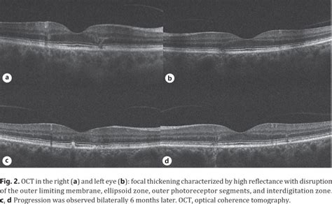 Multifocal Pattern Dystrophy Simulating Fundus Flavimaculatus