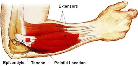 Right Elbow Extensor Tendonitis