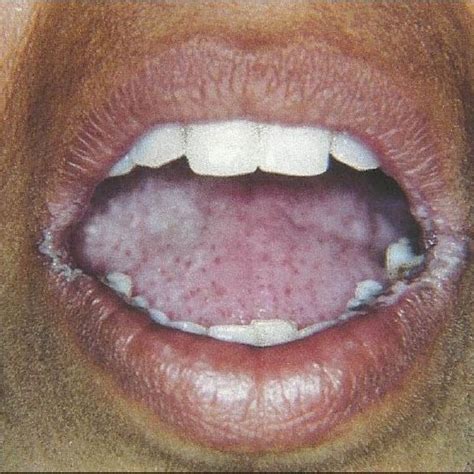 Comparative Microbiology Of Angular Cheilitis In Nine Hiv Seropositive