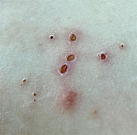 Rash On Ankle What Is It Rdermatologyquestions