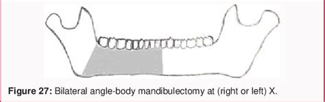 Figure 4 From Classification Of Mandibulectomymandibular Defects