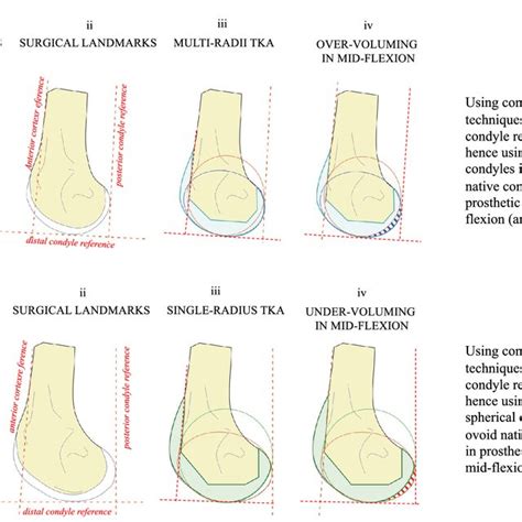 Discrepancy Between The Profile Of The Native Condyles And The Download Scientific Diagram