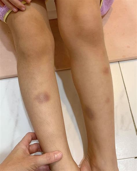 唉⋯姐姐上小學後最明顯的改變就是⋯⋯ 。。。每天都有新的黑青😩 哈囉吳小妮 Hello Minnie Wu