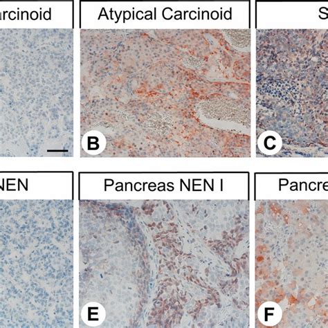 Representative Staining Patterns Obtained In Bronchopulmonary A C And Download Scientific