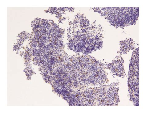Cell Block Preparation From The Residual FNAC Specimen A Neoplastic