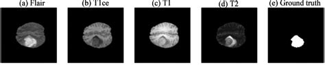 Brain Tumor Segmentation Using U Net In Conjunction With Efficientnet Pmc