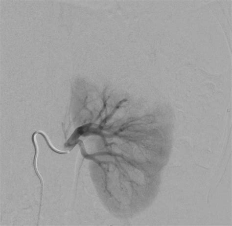 Renal Angiomyolipoma Embolization Consulting Radiologists