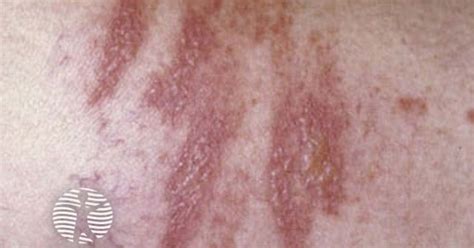 Pigmentary Phytophotodermatitis Image