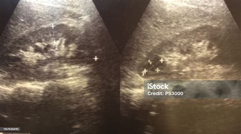 Usg Ginjal Manusia Dengan Kista Ginjal Foto Stok Unduh Gambar