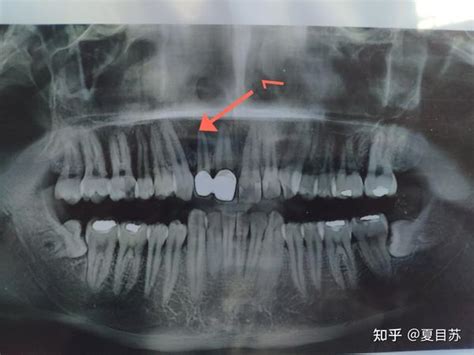 我的根尖囊肿切除经历 知乎
