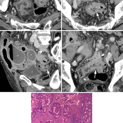 Perforated Diverticulitis In The Descending And Sigmoid Colon Of A Download Scientific Diagram