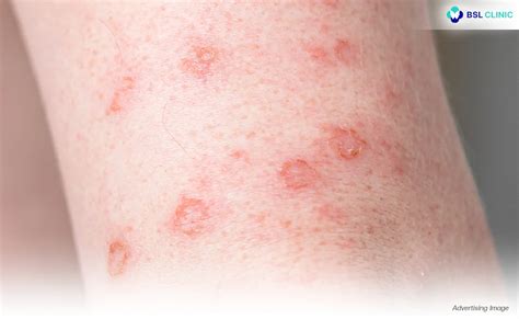 Dermatitis Eczema And Skin Rash Bsl Clinic
