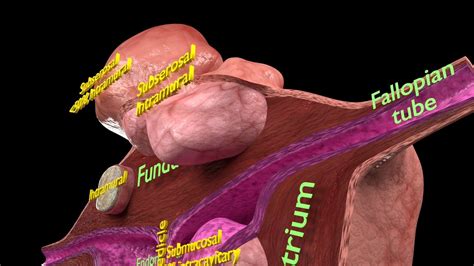 3d Model Fibroid Uterus Human Female 3d Vr Ar Low Poly Cgtrader