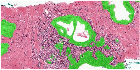 Pathologist Level Gleason Grading Using Artificial Intelligence Ai