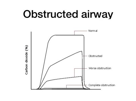 Capnography In Emergency Room